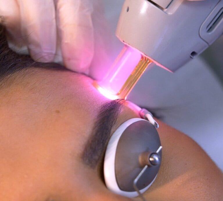 Laser Treatment For Eyebrows: Your Guide to Flawless Brows
