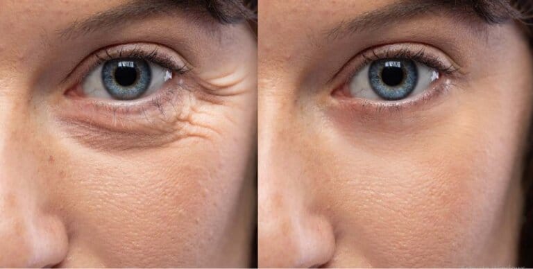 Botox Eyebrow Lift: Enhance Your Arch and Rejuvenate Your Look